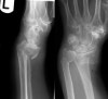 원위 요골 골절distal Radius Fracture 중년 여성이 팔을 짚으면서 넘어지면서 손목 통증이 생겼어요